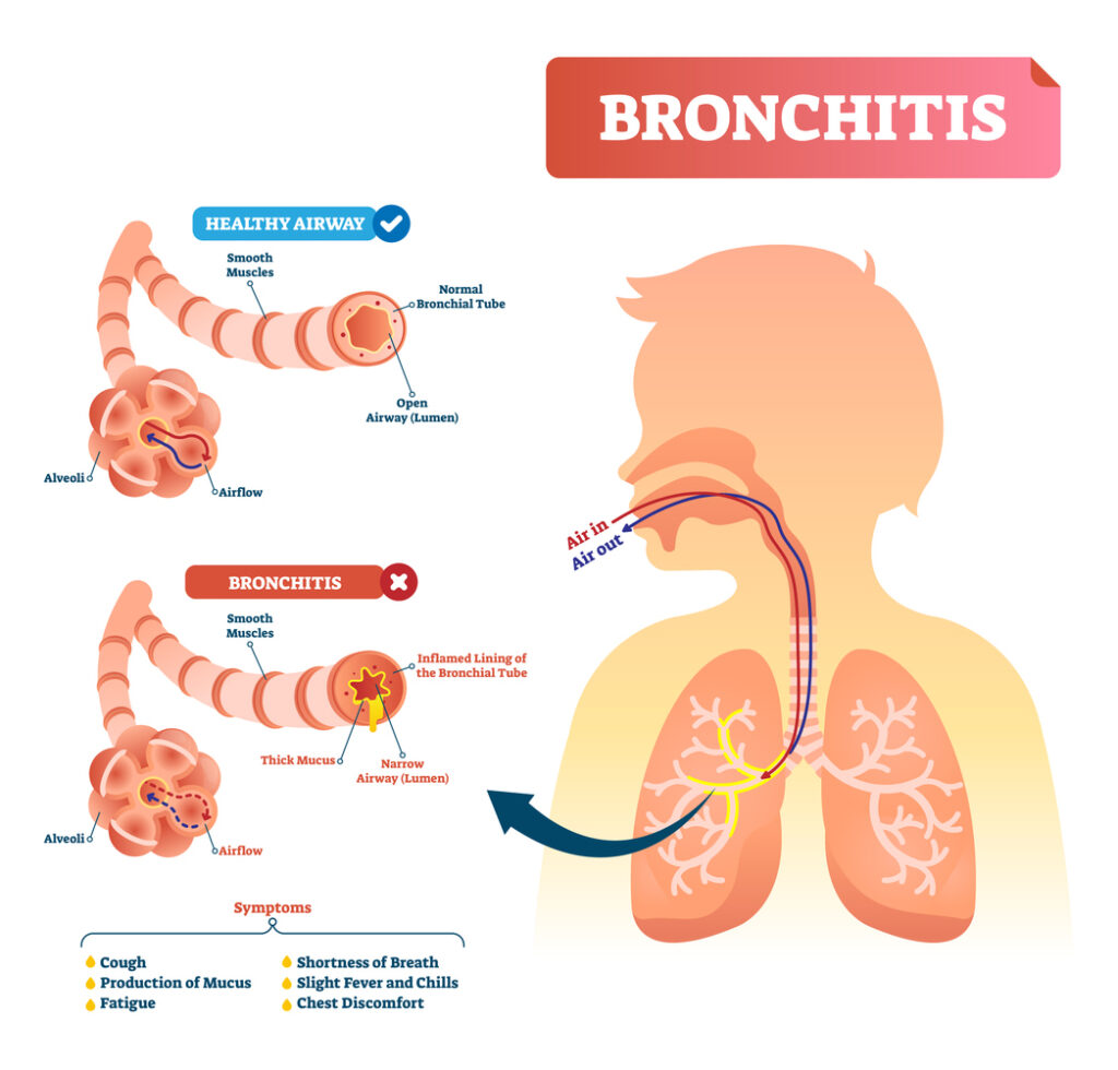 Bronchitis: What Happens in Your Lungs - Advanced Medical P.A.